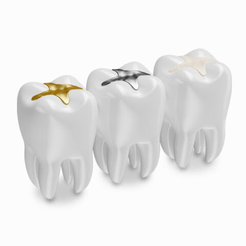 Composite Fillings – sinanak.com